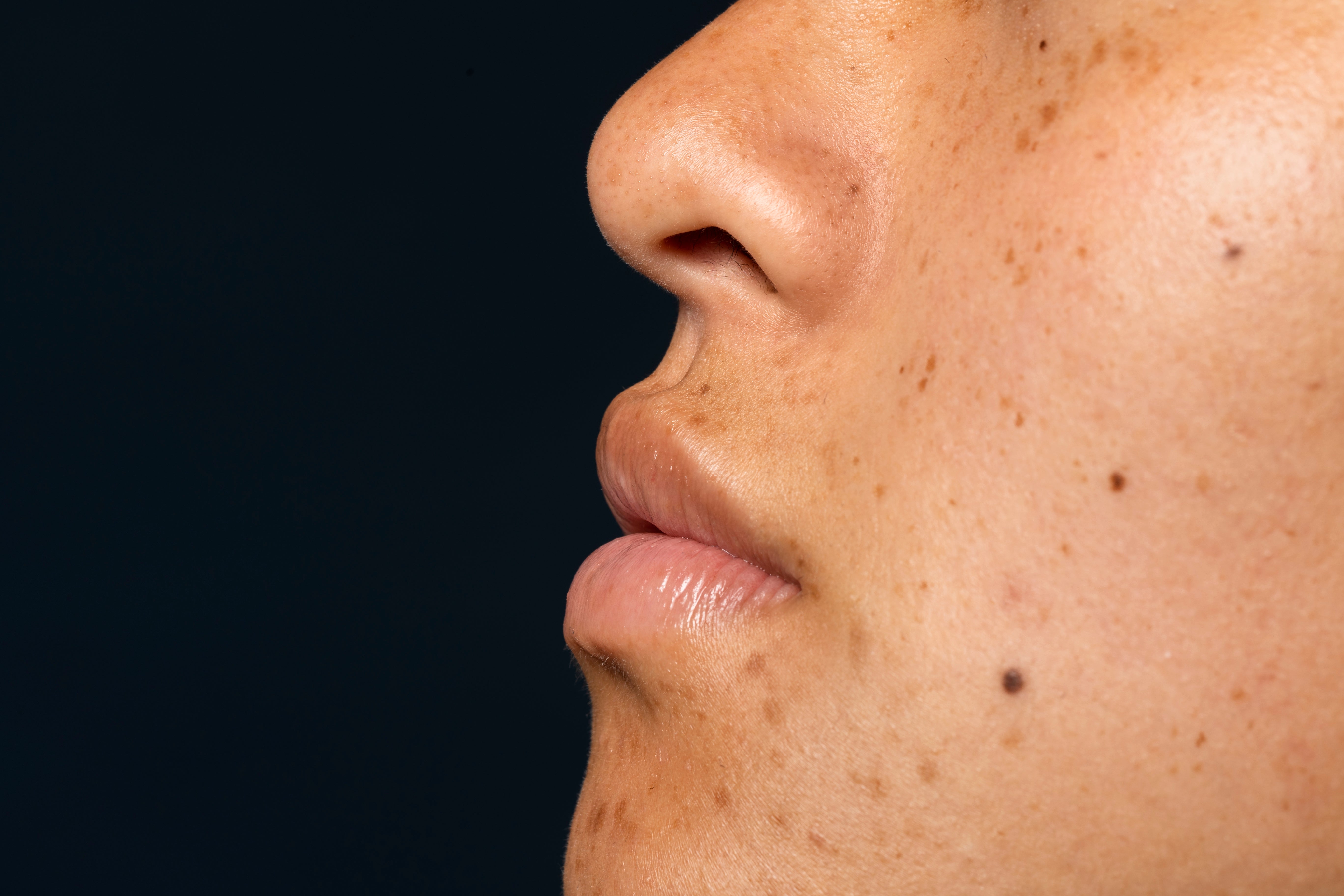 Flek Hitam Membuat Kurang Percaya Diri? Cobalah Terapi Laser untuk ...