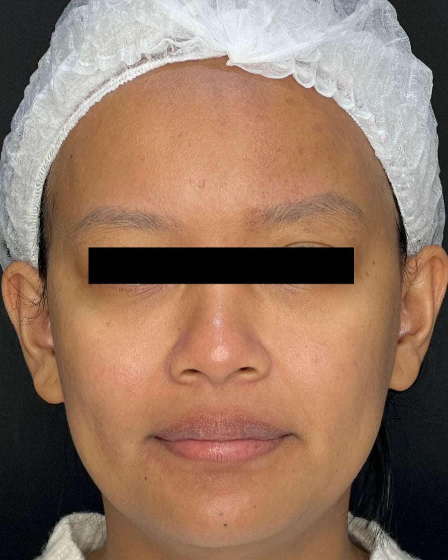 acne – ADC- Aesthetic Derma Centre