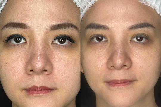 PicoSure® Pro – ADC- Aesthetic Derma Centre